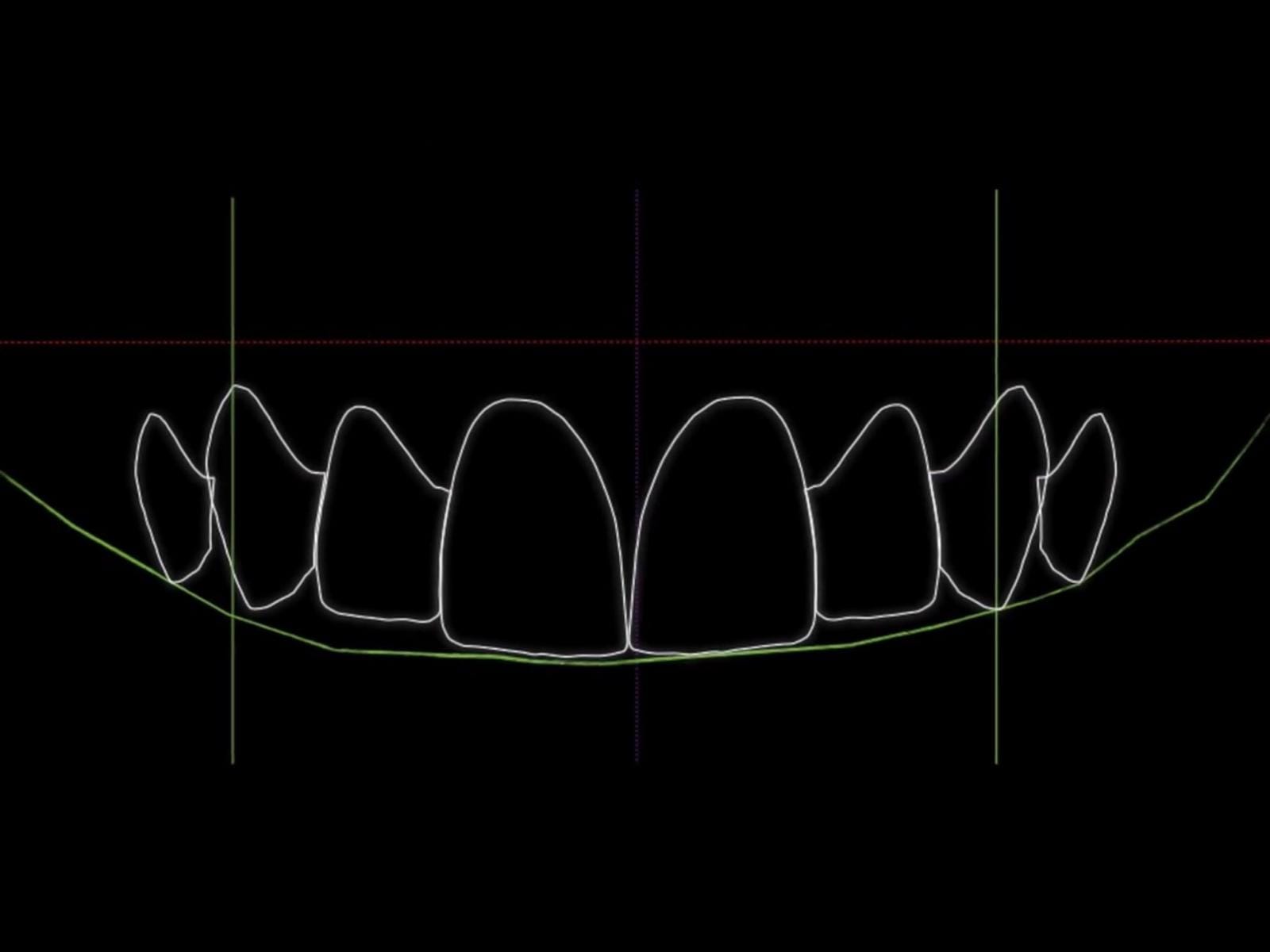 Digital Smile Design | Dental McLeod